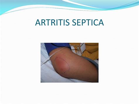 Ppt Artritis Septica Powerpoint Presentation Free Download Id5740413
