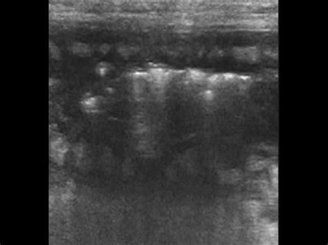 Abdomen And Retroperitoneum 17 Peritoneum Mesentery And Omentum
