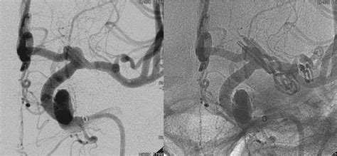 Pipeline Embolization Of Residual Ruptured Aneurysm