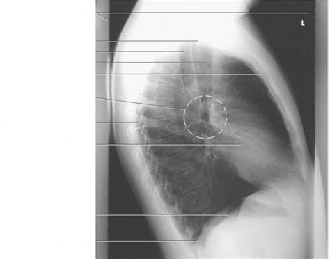 Cxr Lateral Quiz