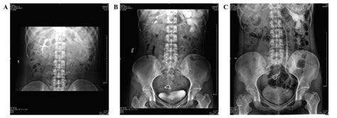 Upper Urinary Tract Retrograde Pyelography Rgp Plus Intravenous