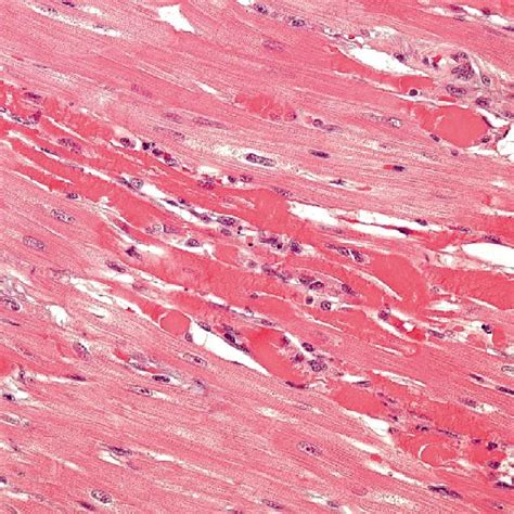 Pancreas Ectopic Splenic Tissue Splenic Tissue Consisting Of Red And Download Scientific
