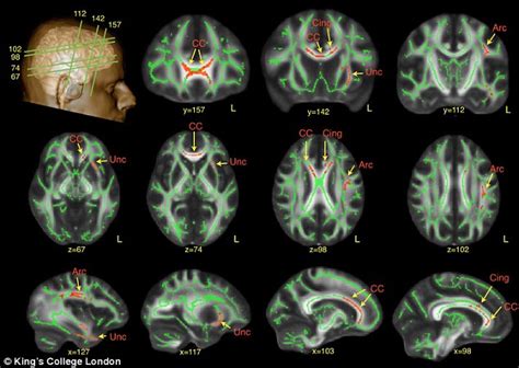 Scans Of Autistic Brains Reveal Differences Involved In Language And