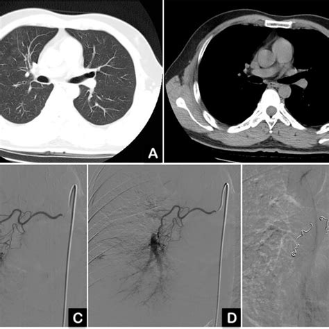 High Resolution Chest Ct Hrct And Digital Subtraction Angiogram Download Scientific Diagram