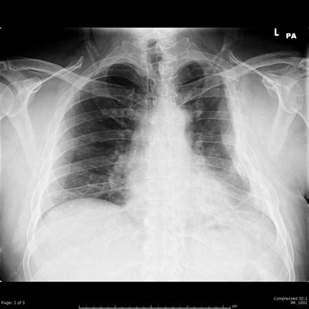 Flail Chest X Ray