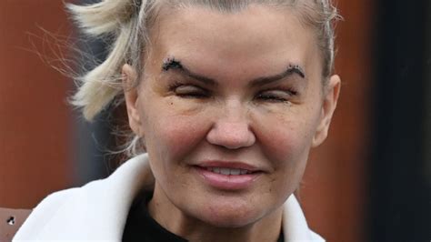 Jaw Dropping Photos Of Atomic Kitten Star Kerry Katona Post Eyelift