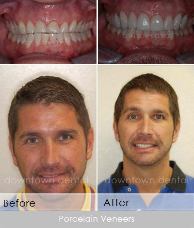 1 Porcelain Veneers Before And After Porcelain Veneers Dental