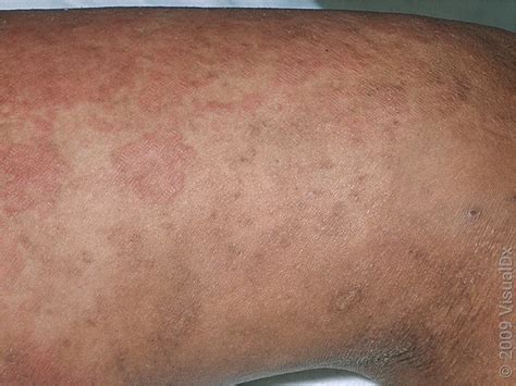 Drug Rashes 7 Medications That Can Cause Skin Reactions Goodrx