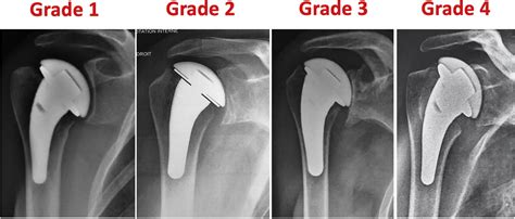 Short Term Outcomes And Survival Of Pyrocarbon Hemiarthroplasty In The