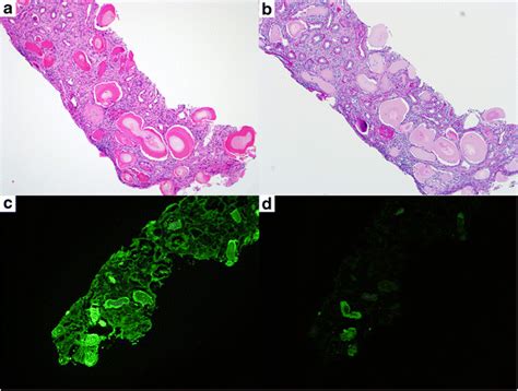 Renal Biopsy Findings In A Patient With Kappa Type Myeloma Cast