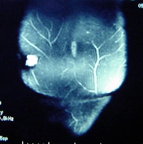 Desmoid Surgery Photos