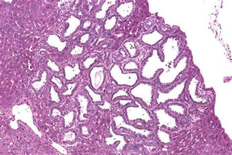 Cholangioma National Institute Of Environmental Health Sciences