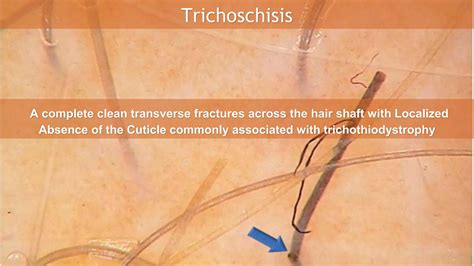 Hair Loss And Trichoscopy Pptx