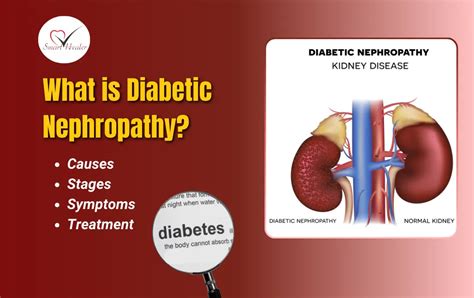 What Is Diabetic Nephropathy Causes 5 Stagessymptoms And Best
