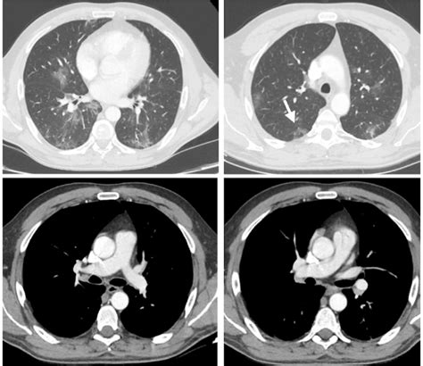 Peripheral Patchy Ground Glass Peribronchovascular Infiltrations Are