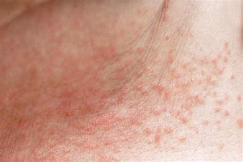 ¿te Salen Granitos Por El Calor No Es Acné Miliaria Cómo Eliminarla