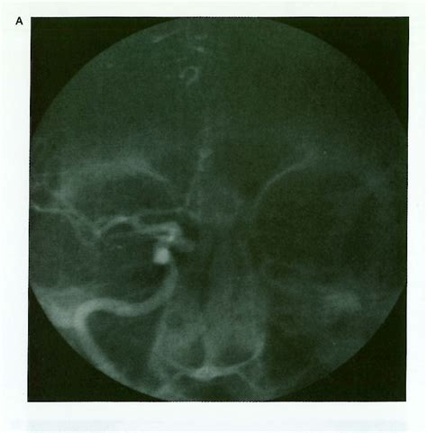 Figure 1 From Trattamento Daneurismi Cerebrali Con Interlocking Detachable Coils Semantic Scholar