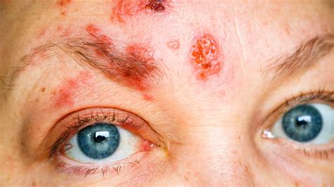 Rash Around Eyes Causes And Treatment Goodrx