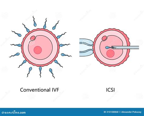 Ivf And Icsi Fertilization Techniques Comparisone Stock Vector