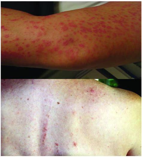 Characteristics And Management Of Rash Following Lenalidomide And
