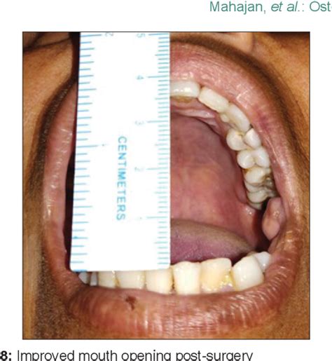 Figure 8 From Giant Osteochondroma Of The Mandibular Condyle And