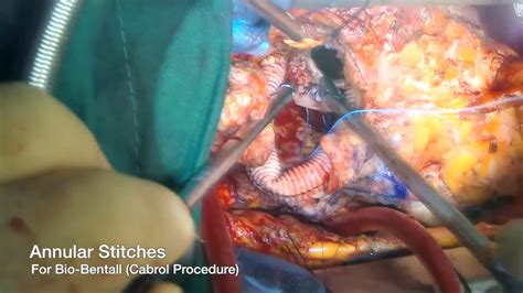 Redo Aortic Root Replacement Cabrol Procedure And Commando Operation