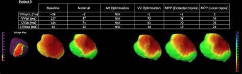 Electrocardiographic Activation Metrics And Directional Activation Maps
