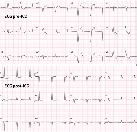 Electrocardiogram Before And After Icd Implantation With Left Bundle