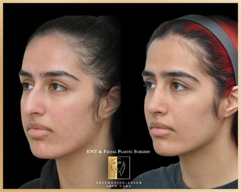 Ent Facial Plastic Surgery Ednan Mushtaq Md Facs Updated November