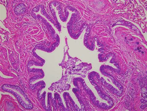 Bronchitis Histology