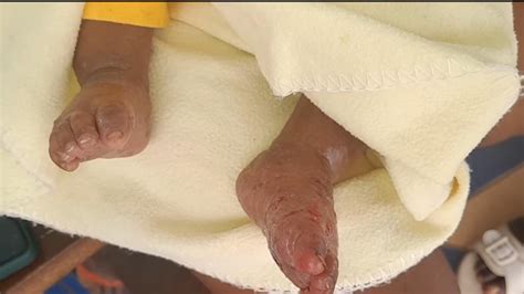 Bitam Un Nouveau Né Agressé Par Un Cochon