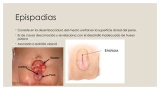 Hipospadias Y Epispadias Diagnostico Y Tratamiento Pptx