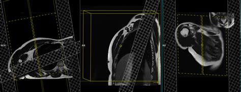 Mri Pectoralis Muscle Protocol Planning And Positioning