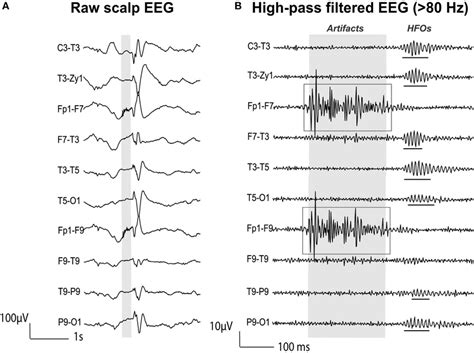 high frequency oscillations hfos vs artifactual oscillations