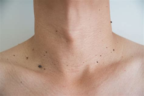 Warts On Face And Neck