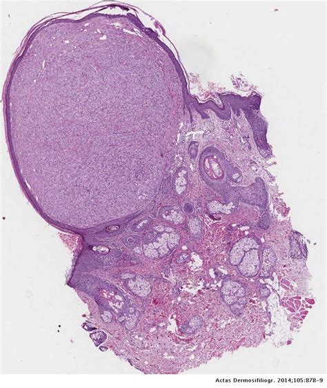 Primitive Polypoid Granular Cell Tumor Actas Dermo Sifiliográficas