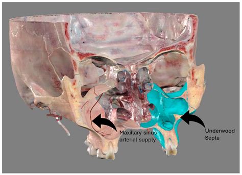 Anatomy Of Maxillary Sinus Focus On Vascularization And Underwood