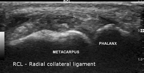 Radial Collateral Ligament Thumb