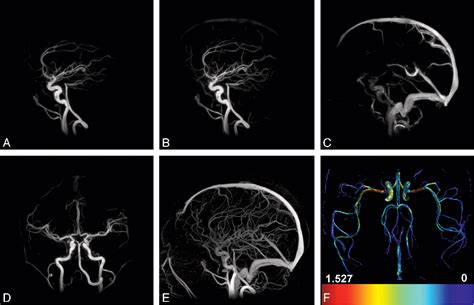 Figure 1 From Fast Whole Brain 4d Contrast Enhanced Mr Angiography With Velocity Encoding Using
