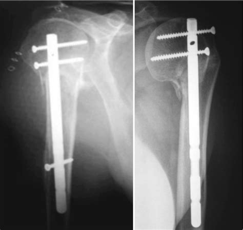 Intramedullary Nail For Proximal Humerus Fractures An Old Concept