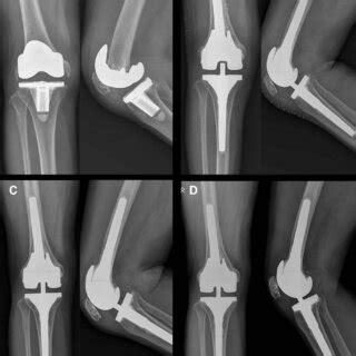 Follow Up Radiographs Taken Nine Years Following The Revision Tka