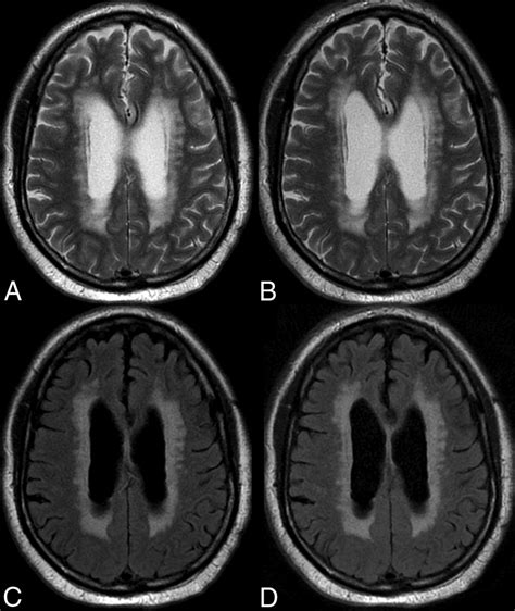 Quiet Propeller Mri Techniques Match The Quality Of Conventional