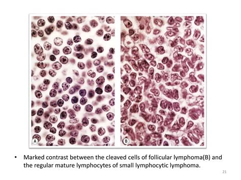 Non Hodgkin Lymphoma Pptx