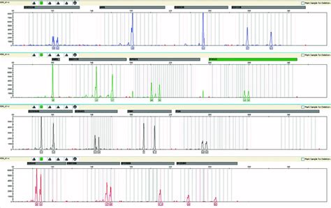 Assessment Of Maternal Fetal Chimerism Exemplified By The Female