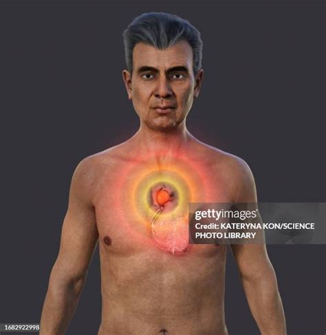 Aortic Rupture Photos And Premium High Res Pictures Getty Images