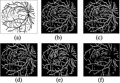 Figure 16 From Unsupervised Automated Retinal Vessel Segmentation Based On Radon Line Detector