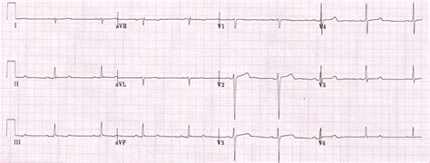 Left Posterior Fascicular Block Lpfb Ecg