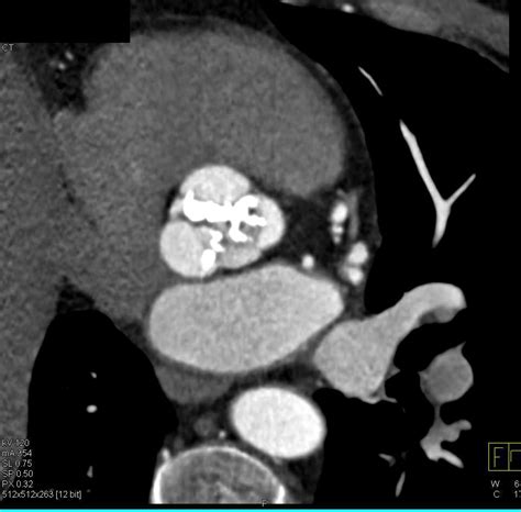 Aortic Stenosis With Extensive Aortic Valve Calcification Cardiac
