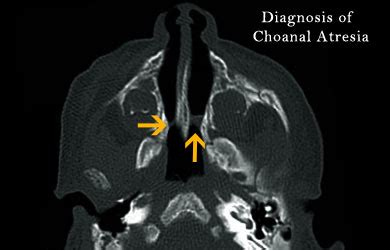 Choanal Atresia Causes Symptoms Diagnosis Treatment And Prevention