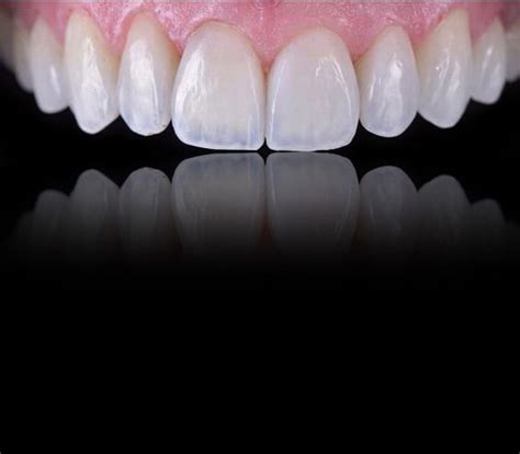 Imersão Em Resina Composta Verthos Instituto De Odontologia Integrada